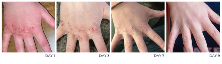 DuraDerm SPORT | Liquid Bandage, Infection Prevention