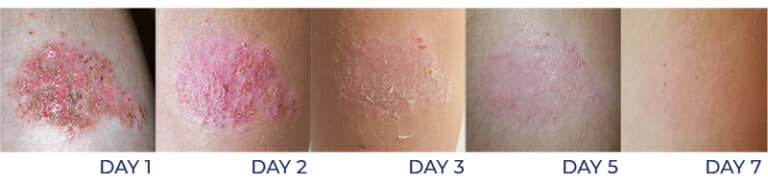 Skin rashes hockey players know all too well