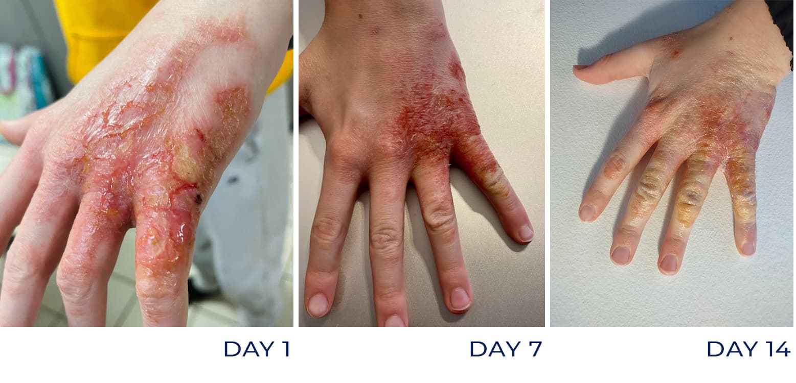 My son developed eczema last hockey season. Only we didn't know it at ...