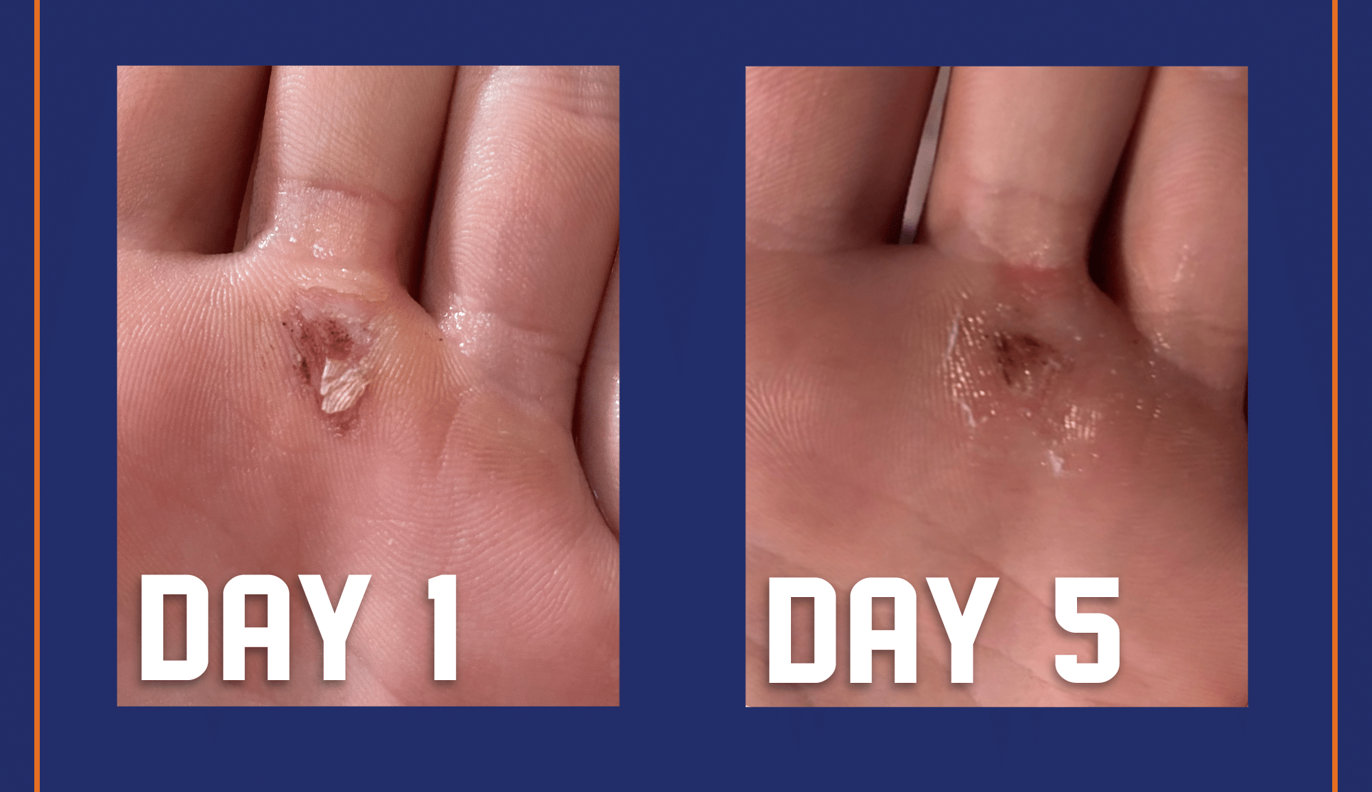 Don't Get Sidelined! Prevent and Treat Baseball Blisters with DuraDerm ...