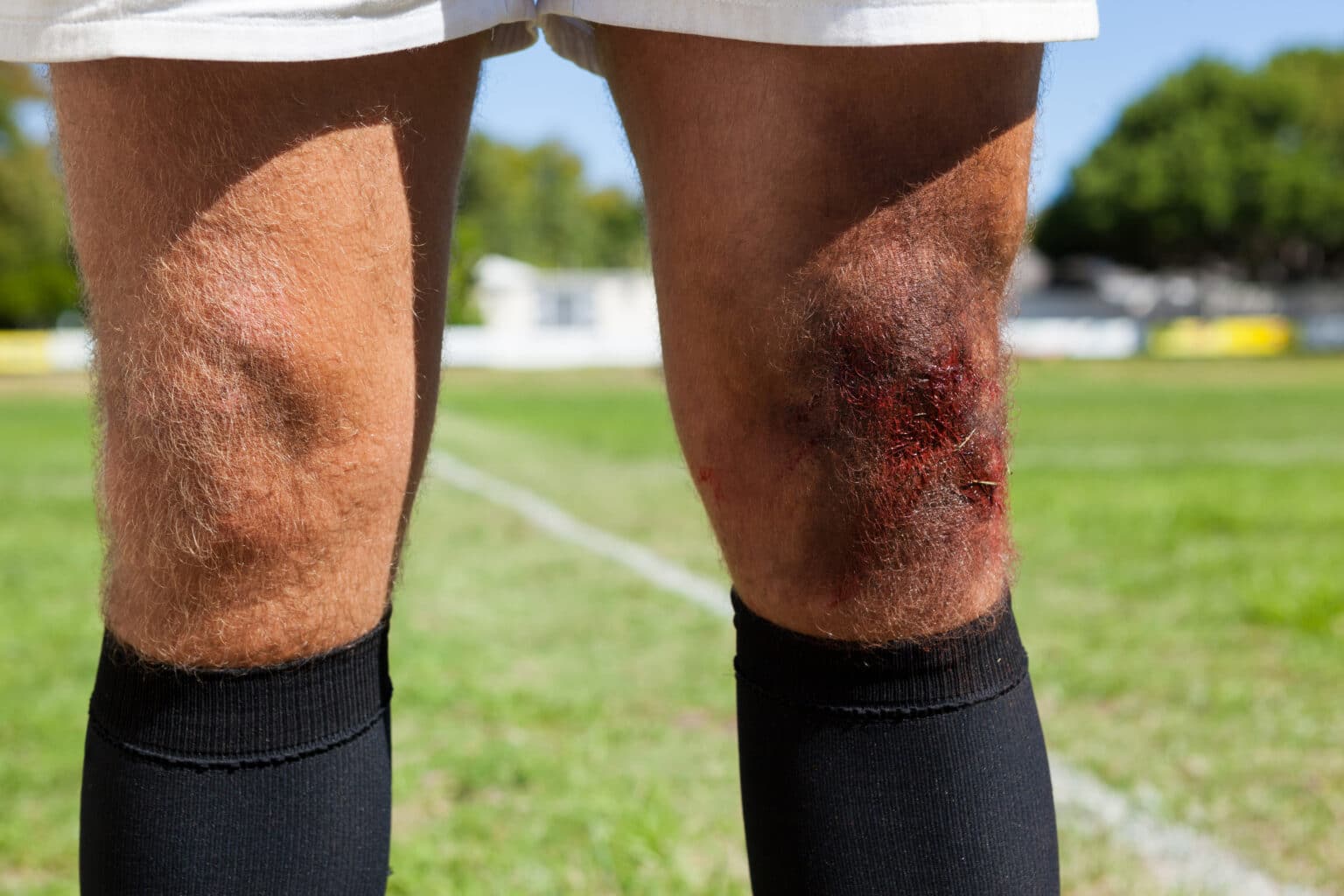 Turf Burn: The Athlete's Guide to Prevention and Treatment | DuraDerm SPORT