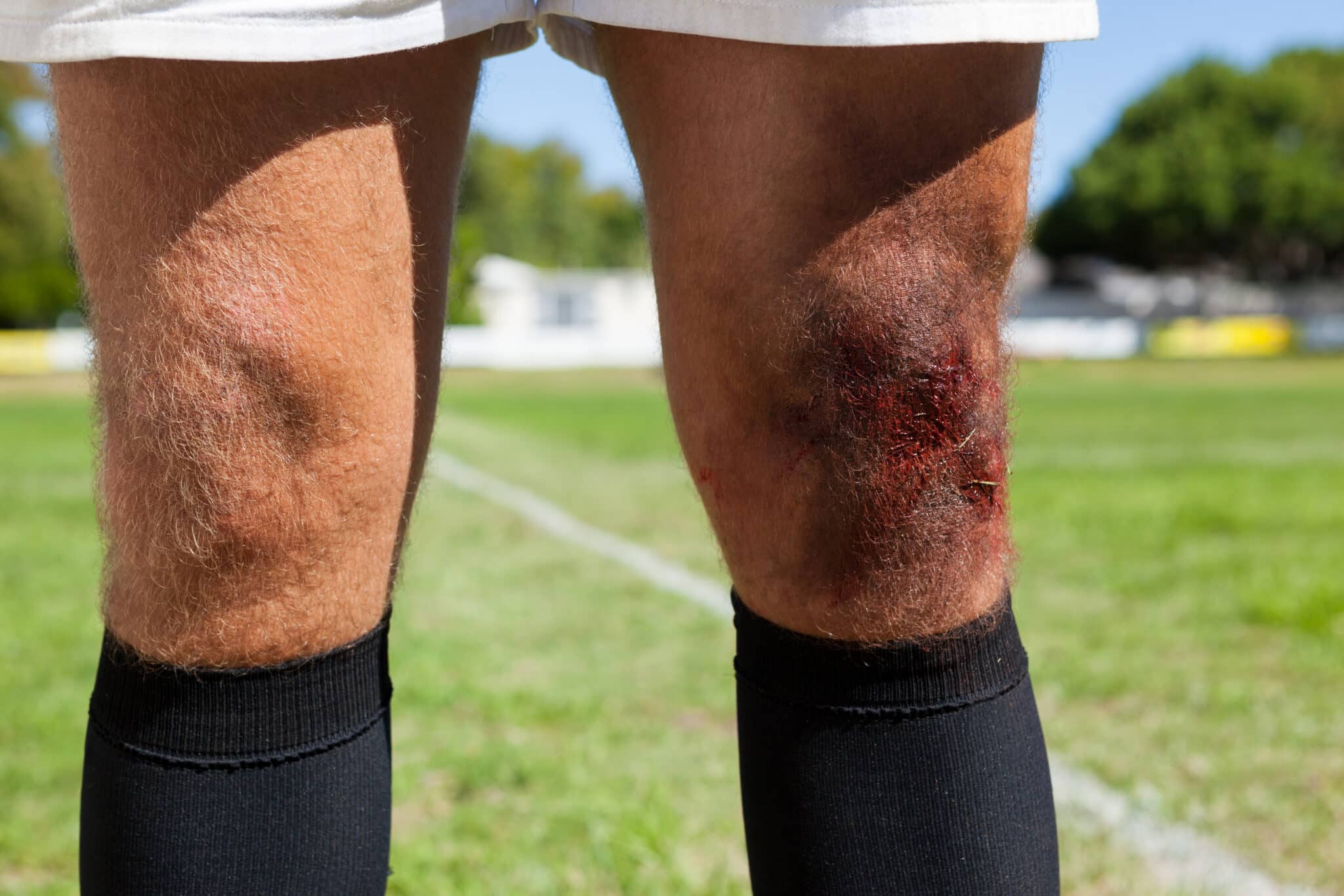 Turf Burn: The Athlete's Guide to Prevention and Treatment | DuraDerm SPORT